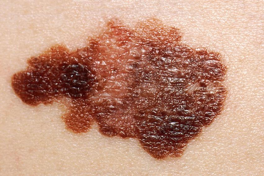 Early Skin Cancer Pictures | LoveToKnow Health & Wellness