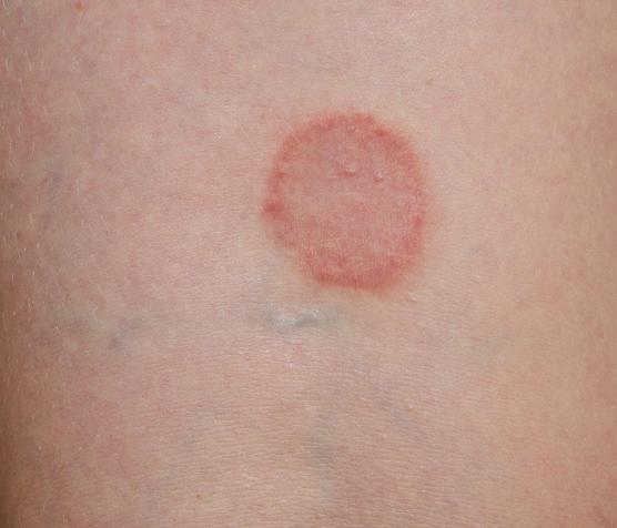 Pictures of Skin Rashes | LoveToKnow Health & Wellness