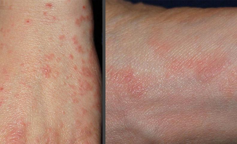 Pictures of Skin Rashes | LoveToKnow Health & Wellness