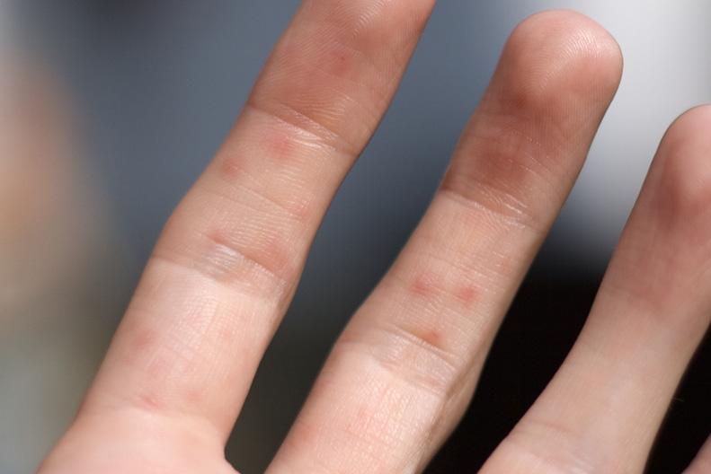 Pictures of Skin Rashes | LoveToKnow Health & Wellness