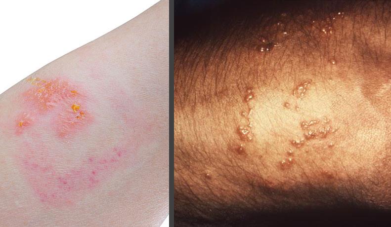 Pictures of Skin Rashes | LoveToKnow Health & Wellness