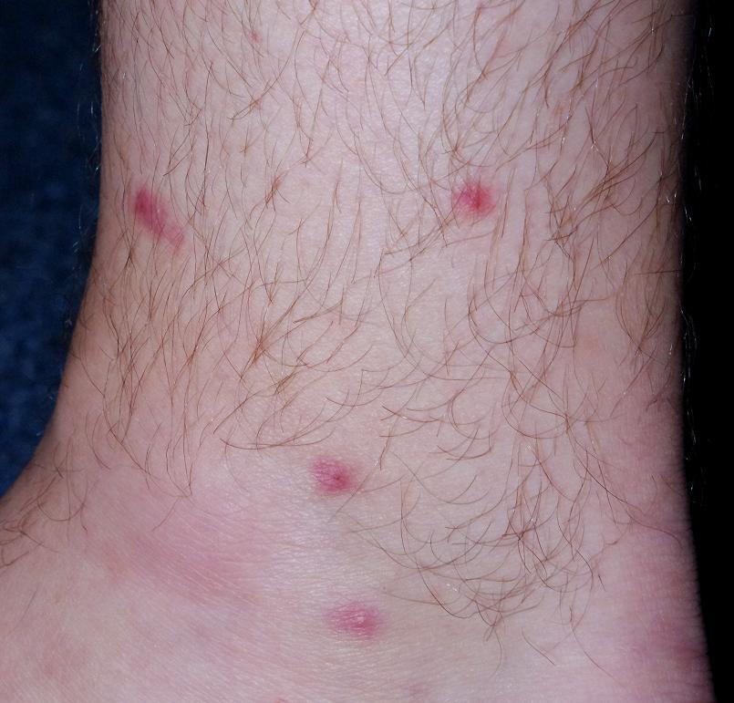 Pictures of Skin Rashes | LoveToKnow Health & Wellness