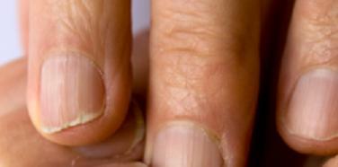 Nail Disorders | LoveToKnow Health & Wellness