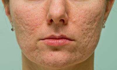 What Makes Acne Scars Vanish? | LoveToKnow Health & Wellness