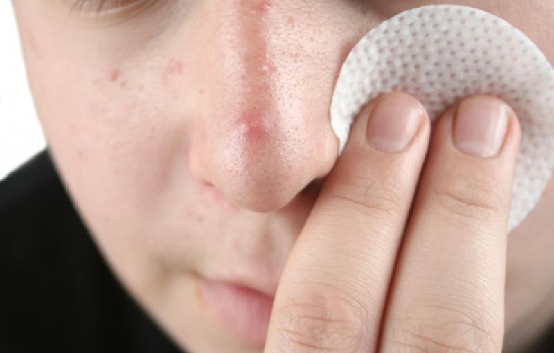 Choosing the Right Acne Cream | LoveToKnow Health & Wellness