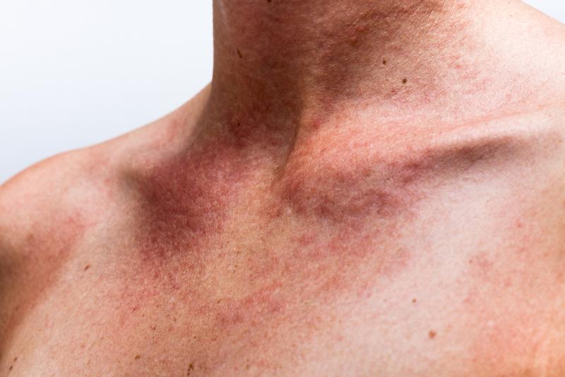 Sun Poisoning Rash | LoveToKnow Health & Wellness