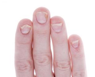 Nail Disorders | LoveToKnow Health & Wellness