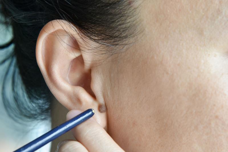 The Meaning of Moles on the Face | LoveToKnow Health & Wellness