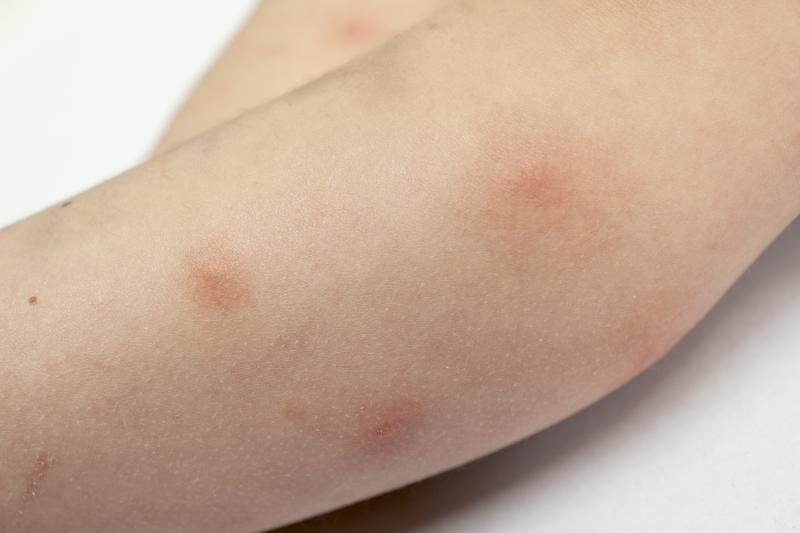 Insect Bite Rash | LoveToKnow Health & Wellness