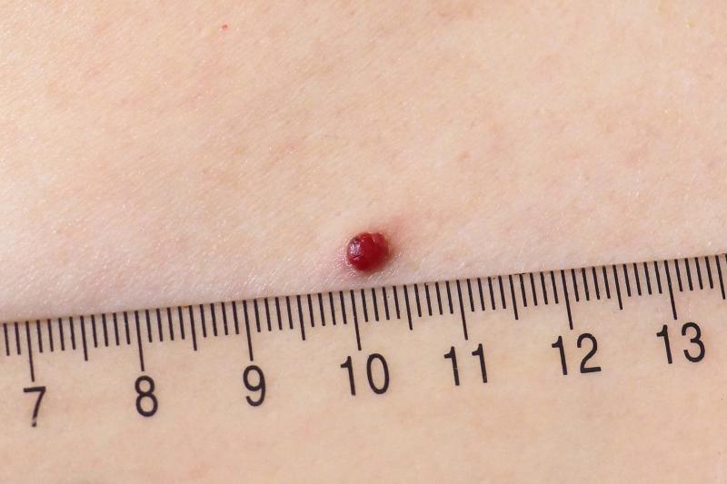 Cherry Angiomas (Red Moles): Causes, Removal, and Treatment ...
