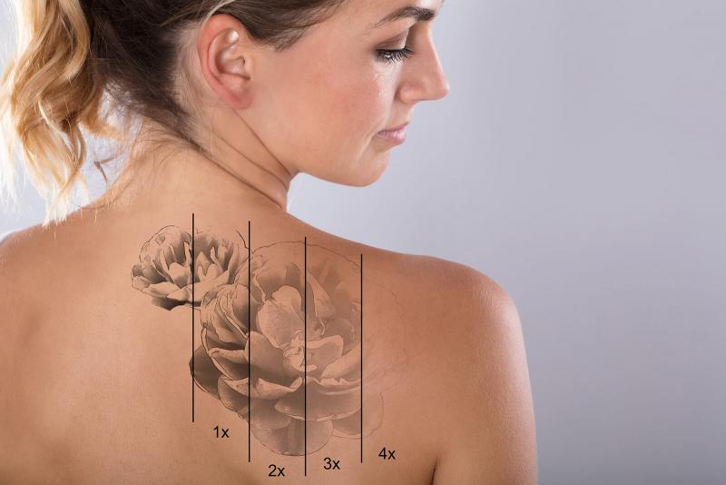 How To Fade A Tattoo With Hydrogen Peroxide Lillia Wilcox