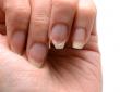 Fingernails Vitamin Deficiency | LoveToKnow